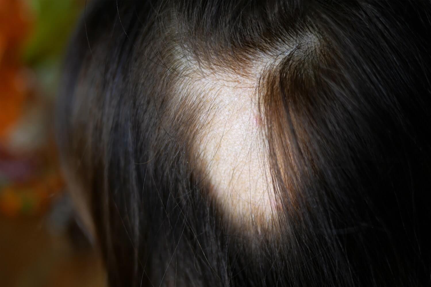 Alopecia Areata: Explaining Autoimmune Hair Loss - Dr Serkan Aygin Clinic
