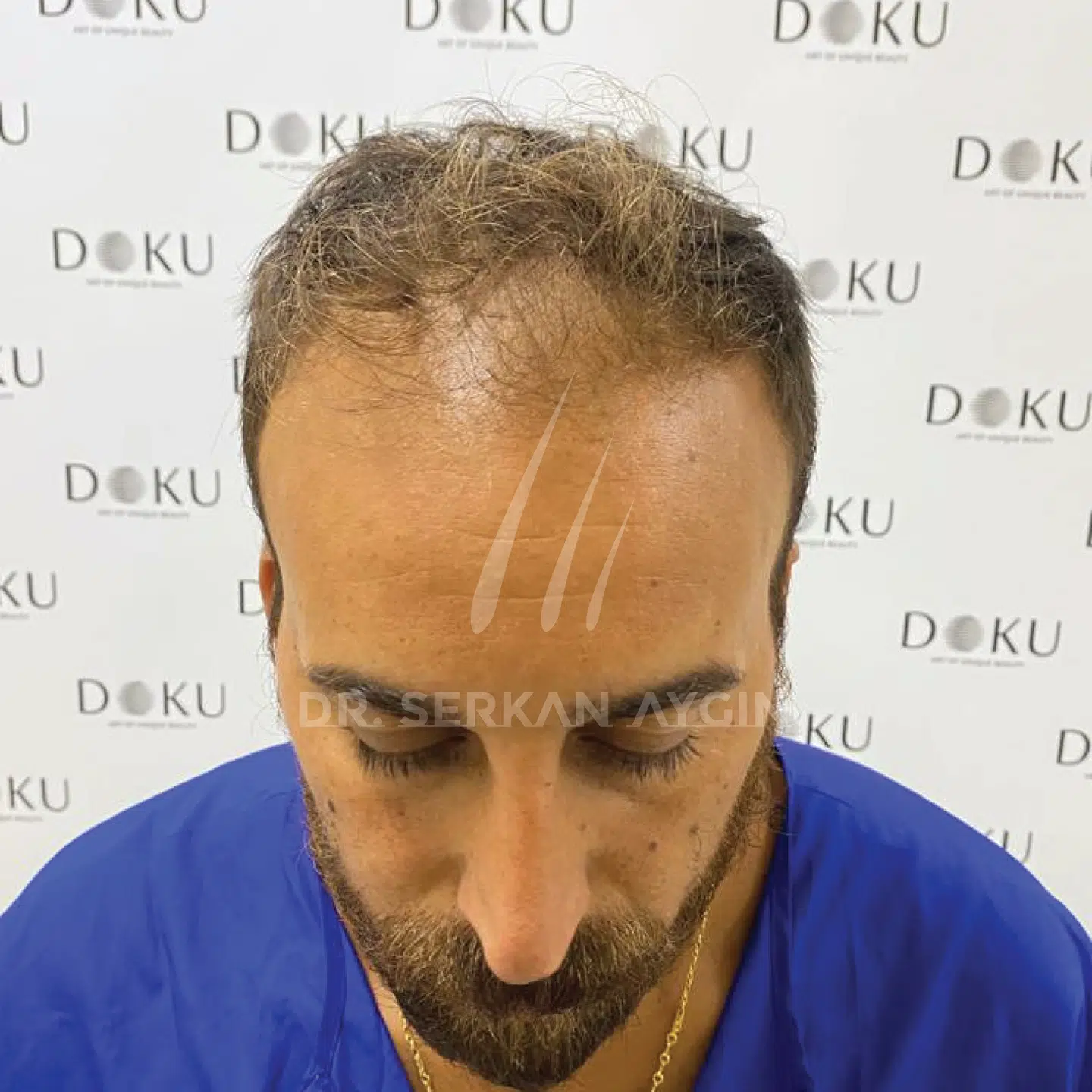 Haartransplantation Türkei Ergebnisse Dr Serkan Aygin Clinic