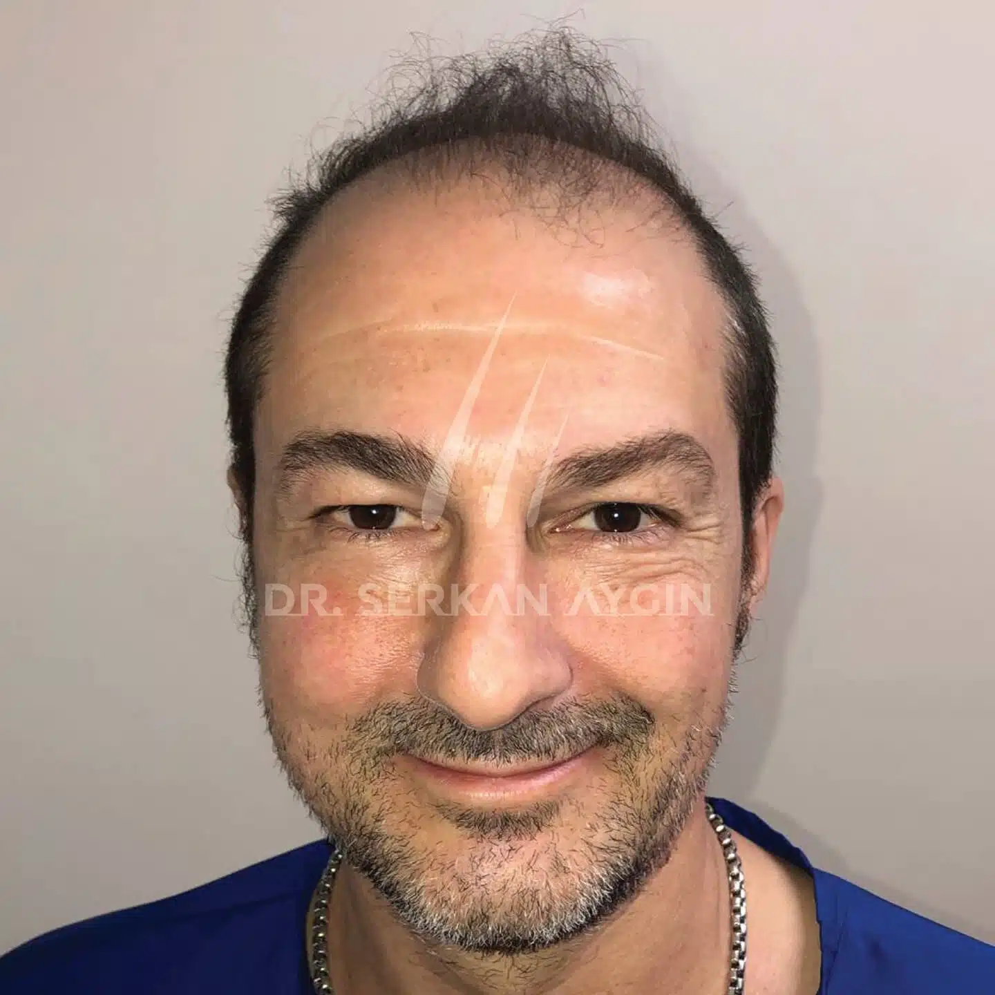 Haartransplantation Türkei Ergebnisse Dr Serkan Aygin Clinic
