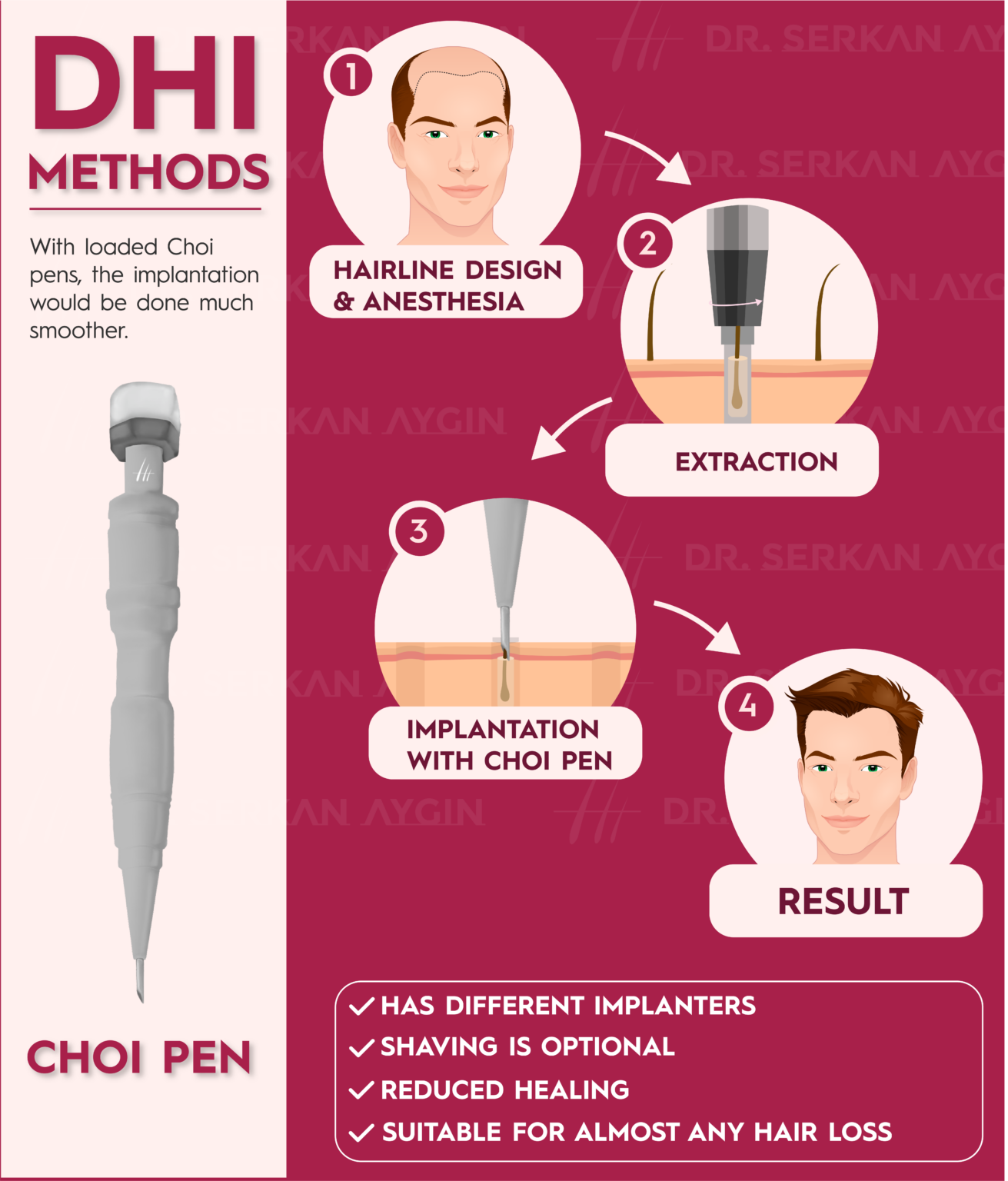 DHI Hair Transplant: Procedure, Choi Pen, Cost & Turkey - Dr Serkan ...