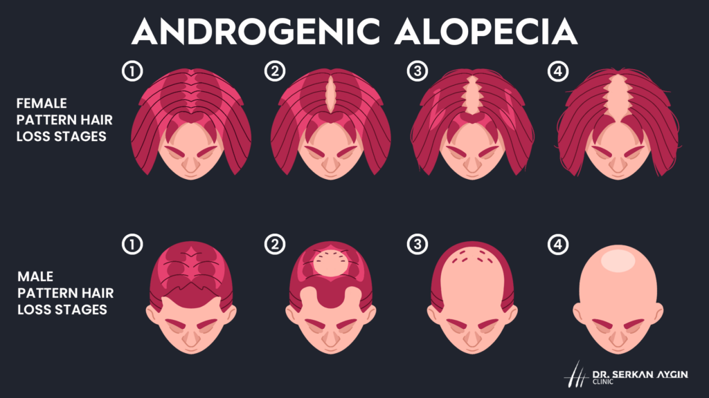 Androgenic Alopecia Causes Symptoms And Effective Treatments Dr