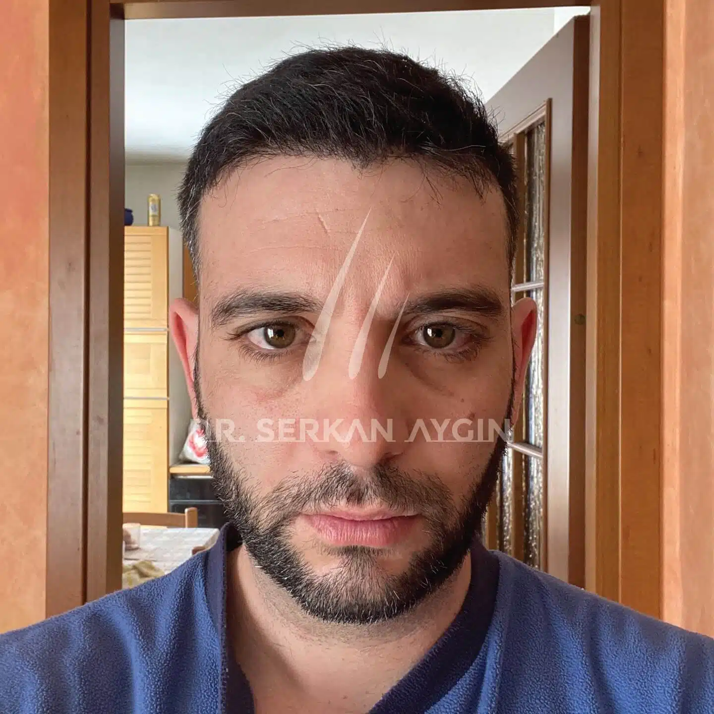 Hair Transplant Turkey Before And After Dr Serkan Aygin Clinic