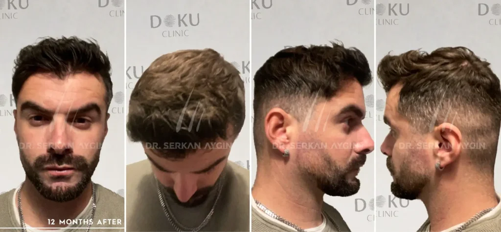 3,400 Grafts DHI Hair Transplant | 1-Year Before & After Result